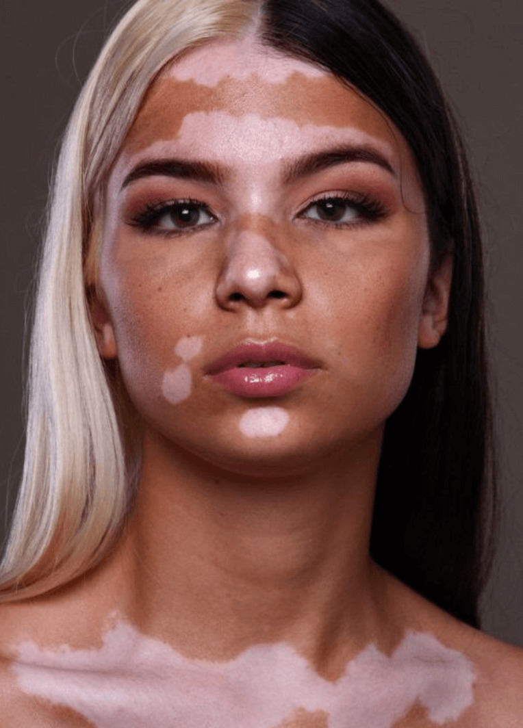 Vitiligo